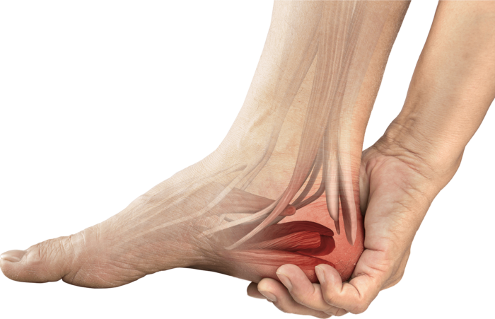 Heel Pain - Plantar Fasciitis - Sydney Podiatry Practice